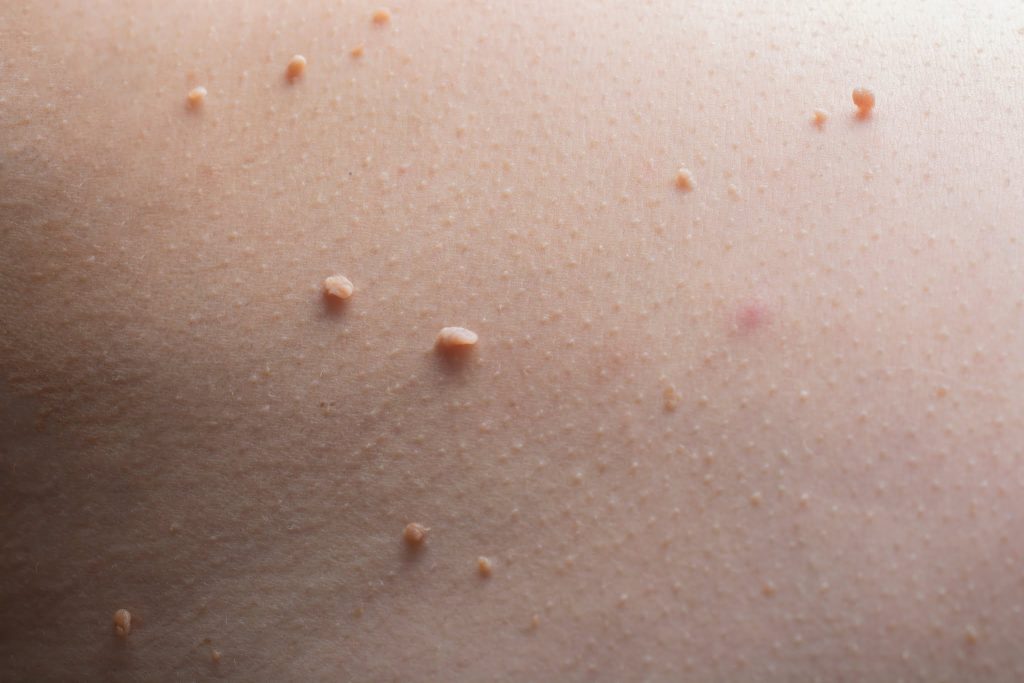 Skin Tag Removal – Chatham Skin Clinic