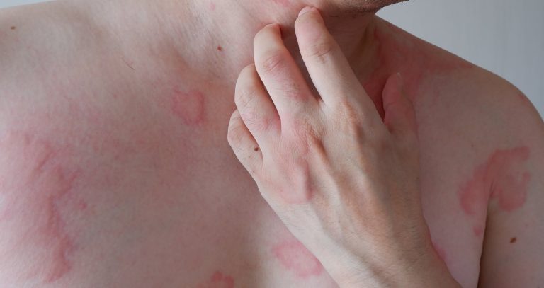 Urticaria (Hives) – Chatham Skin Clinic
